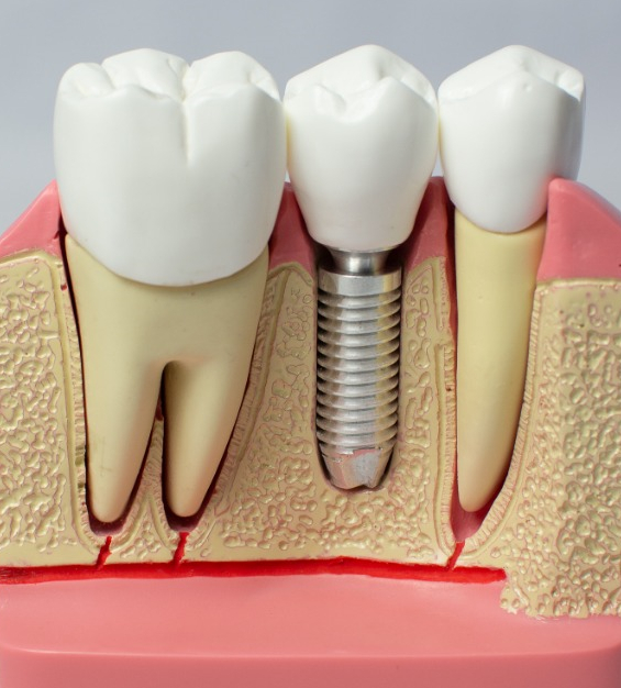 Implantes Dentários - Principais Dúvidas - Nippo Dents